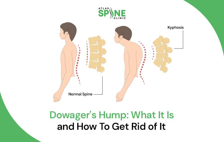 Dowager's Hump: What It Is and How To Get Rid of It - Atlas Spine Clinic