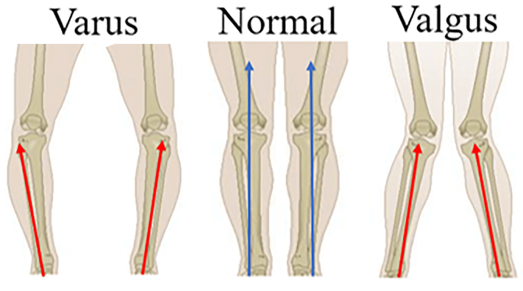 Knees Keep Caving In? Let’s Fix That Knee Valgus for Good - Atlas Spine ...