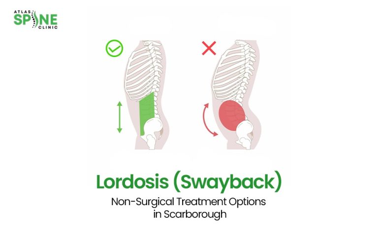 Lordosis (Swayback): Non-Surgical Treatment Options in Scarborough ...
