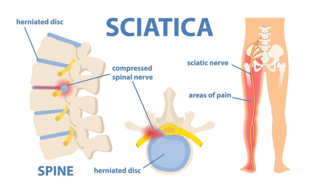 Sciatica Pain Is Nerve Trouble — Here’s How to Get Relief Fast - Atlas Spine Clinic